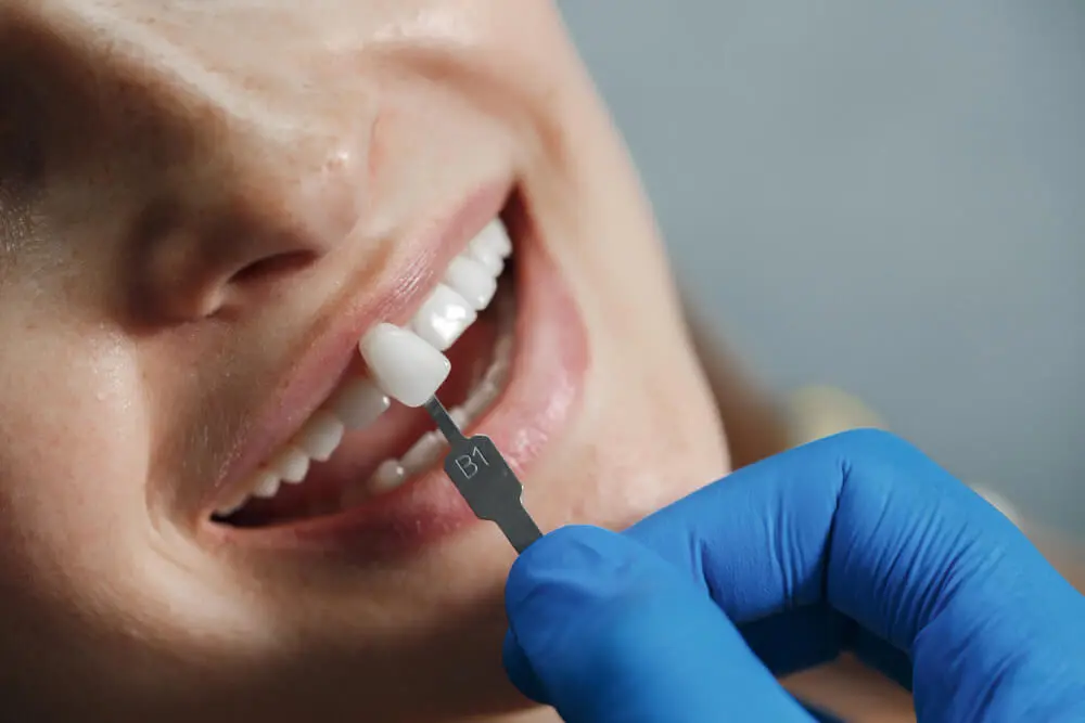 Cantilever Dental Bridge: What It Is, Cost & Benefits
